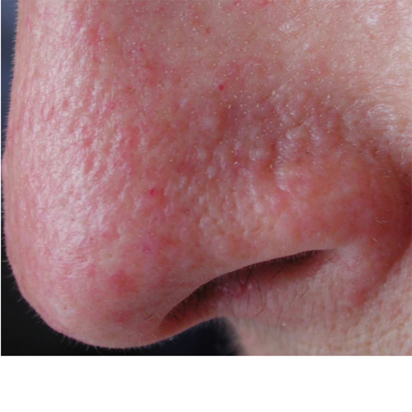 Tumeurs bénignes | Dr. Jean-Claude Katz Dermatologue